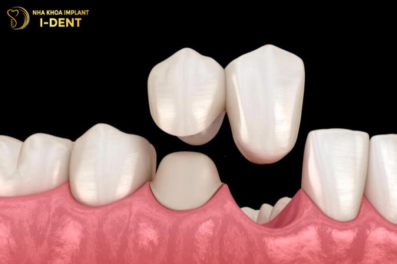 Trồng Răng Sứ Bắc Cầu Là Gì? Có Tốt Không?