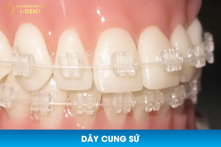 Dây cung niềng răng có mấy loại? Tác dụng từng loại