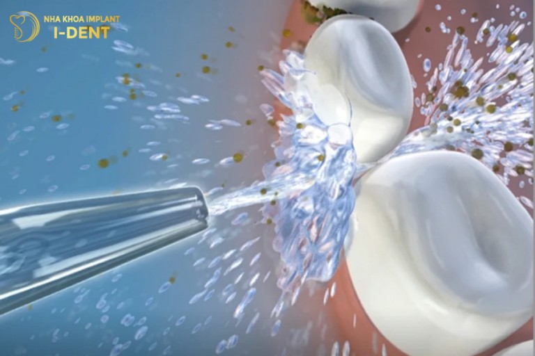 Máy Tăm Nước WaterBeam Có Tốt Không? Ai Nên Dùng?