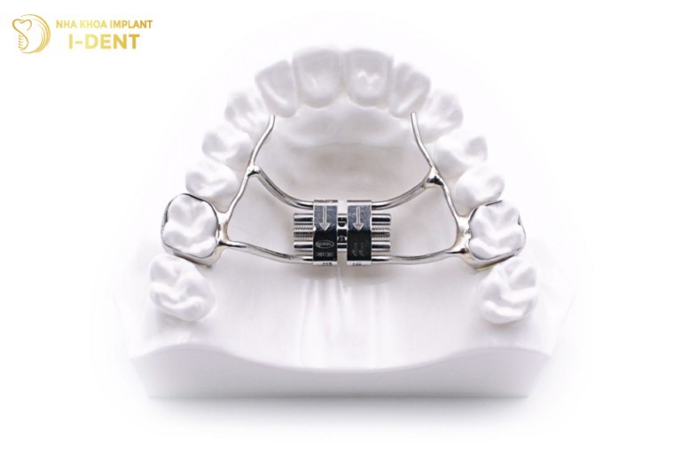 Tìm Hiểu Về Kỹ Thuật Nong Hàm Trong Niềng Răng