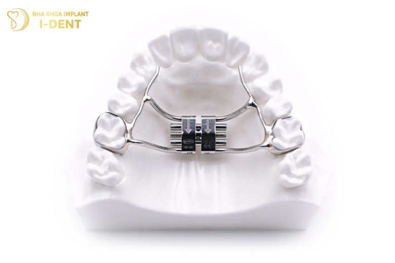 Tìm Hiểu Về Kỹ Thuật Nong Hàm Trong Niềng Răng