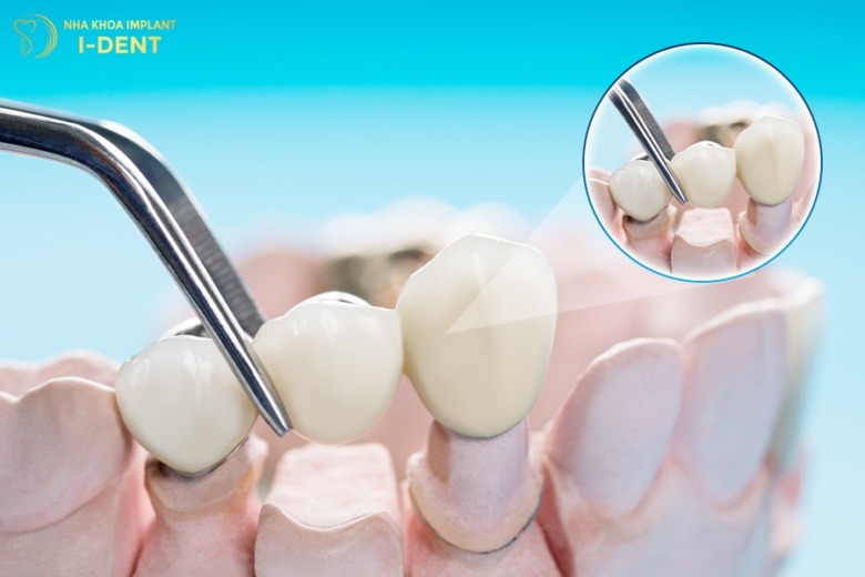 Trồng răng sứ vĩnh viễn: Giá, Nên trồng loại nào và Quy trình - Nha ...