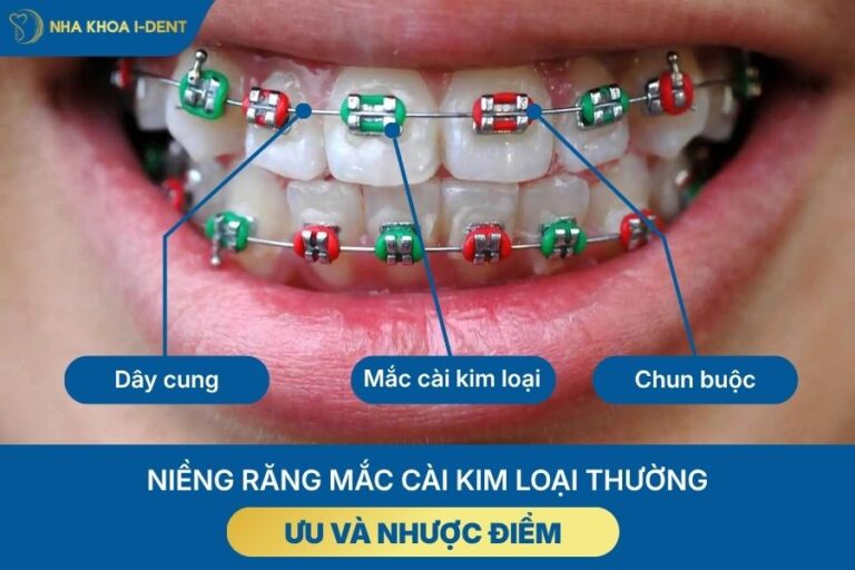 5 Loại Mắc Cài Niềng Răng Phổ Nhất Biến Hiện Nay